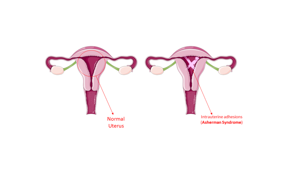 Intrauterine Adhesions (Asherman Syndrome): Infertility and Recurrent ...